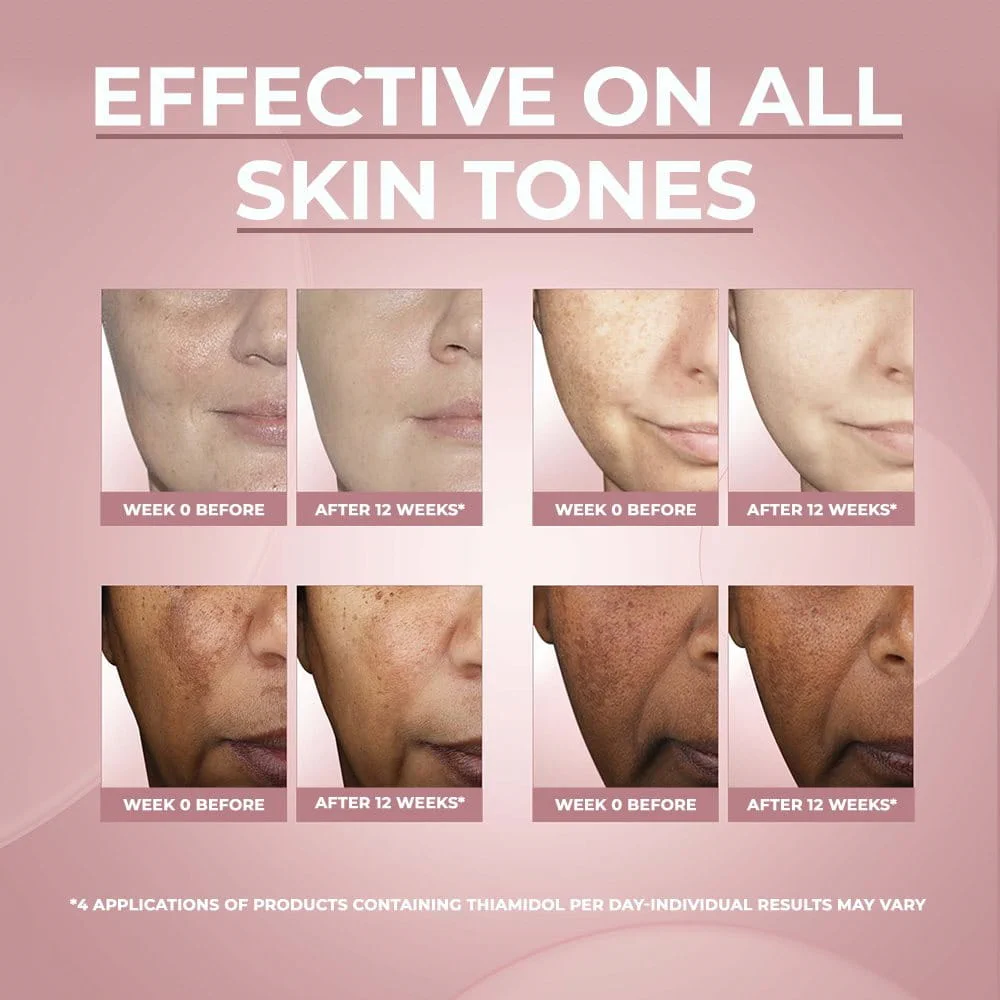 Melasma vs Hyperpigmentation: Key Differences Explained